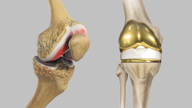 Total Knee Replacement - Kutch Orthopaedic Hospital