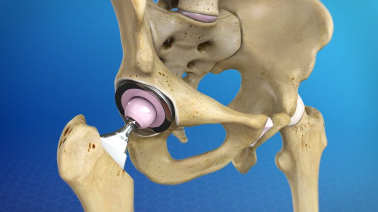 Total Hip Replacement - Kutch Orthopaedic Hospital