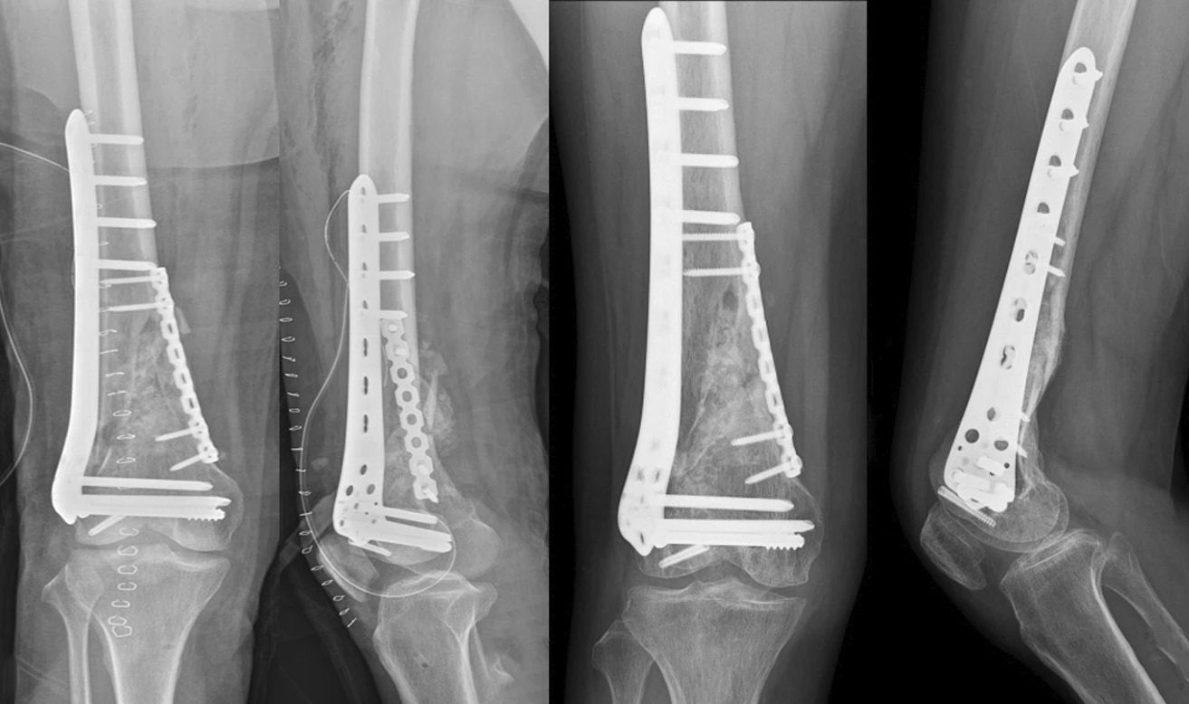 Trauma Surgery - Kutch Orthopaedic Hospital