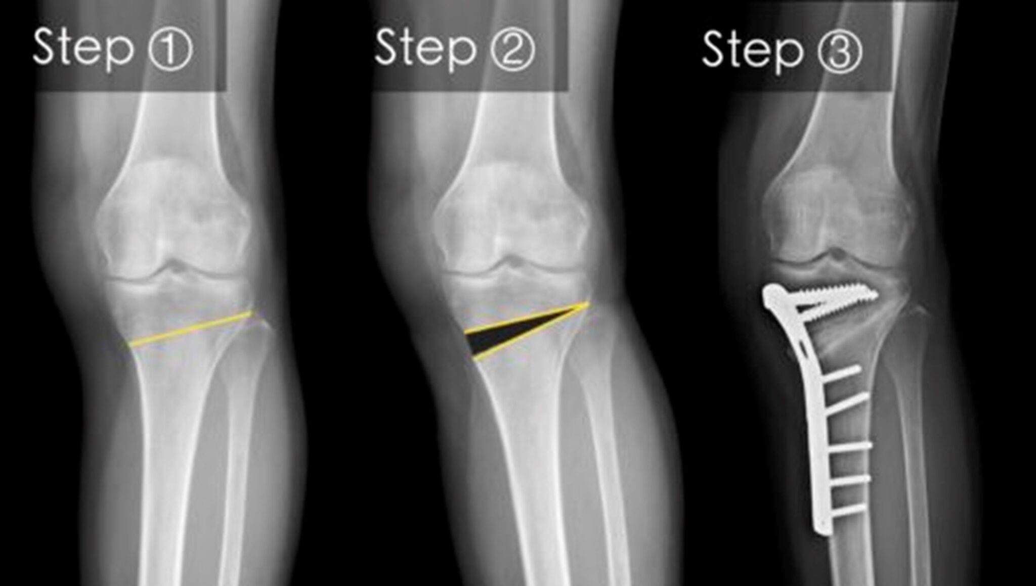 High Tibial Osteotomy (HTO) - Kutch Orthopaedic Hospital